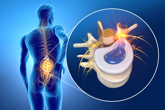 What Are the Long-Term Effects of a Herniated Disc?