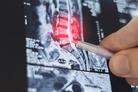 What Is Discectomy with Annuloplasty?