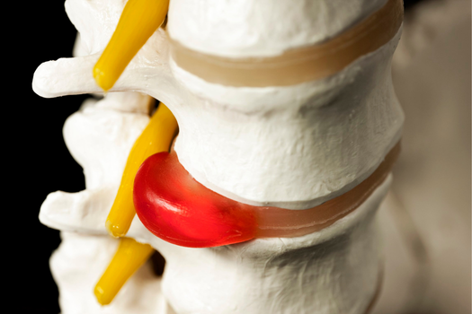 How Long Does It Take for a Herniated Disc to Calcify?