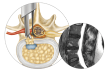 Discectomy 101: The Risks and Results to Understand Before Your Spine ...