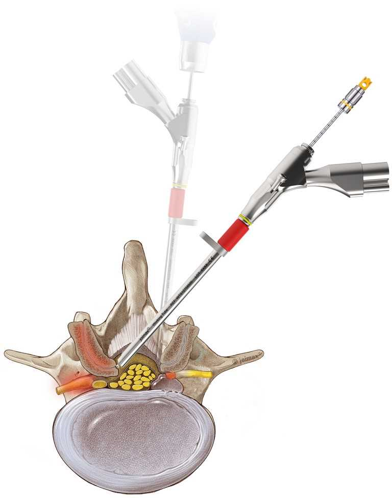 Different Approaches to Lumbar Discectomy Surgery