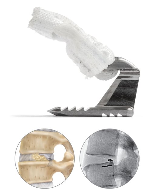 Understanding the Types of Discectomy Surgery