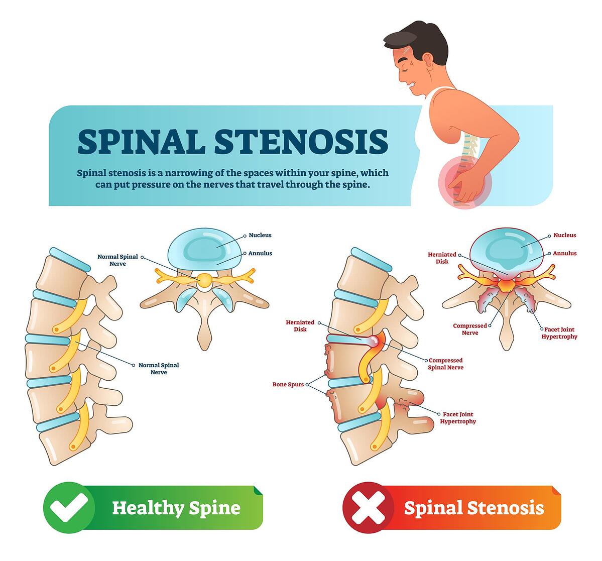 Herniated Disc vs. Spinal Stenosis: How Do They Differ?